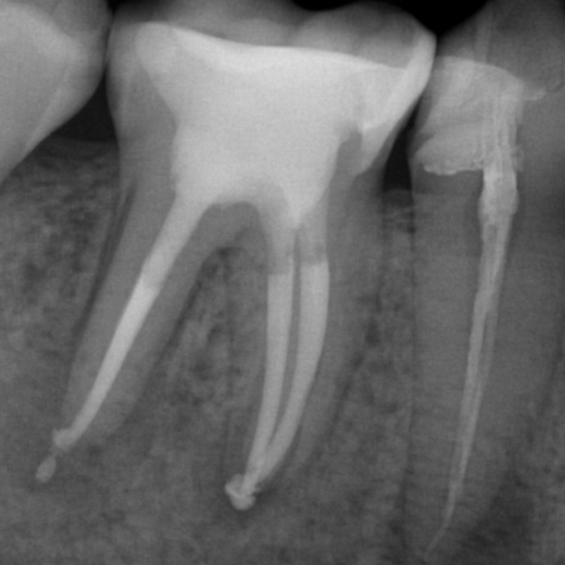 Endodontie Berlin - Fallbeispiele